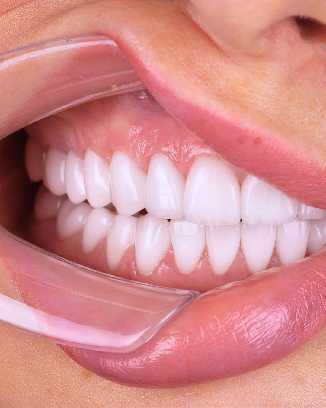 Smile Dental Miami | Porcelain Veneers in Miami